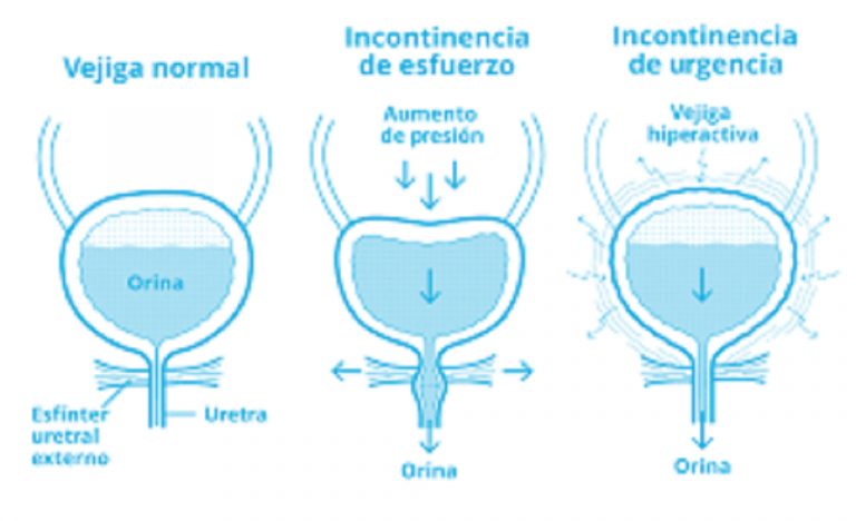 Pérdida de orina durante la menopausia - Ginecoestetica